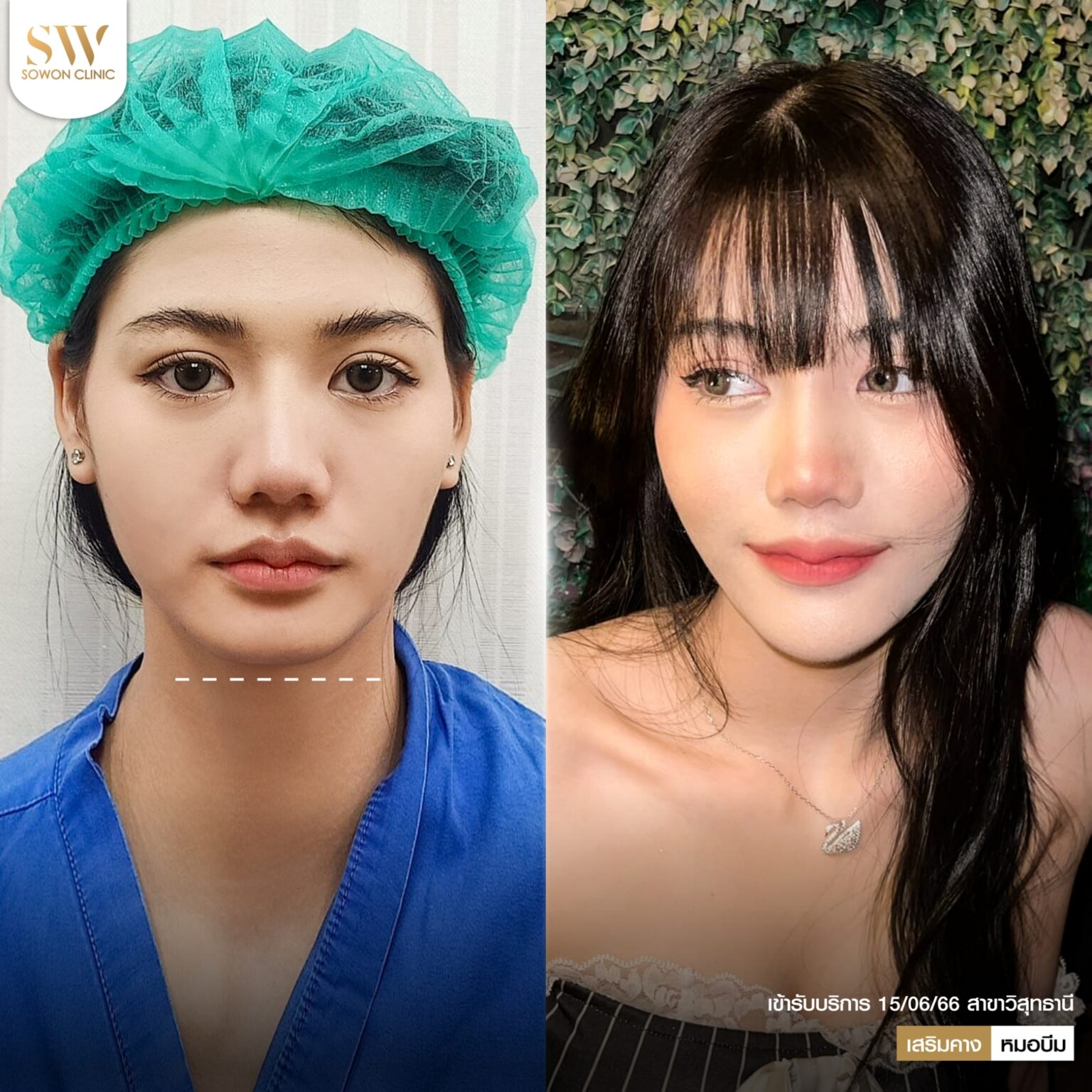 บอกหมดไม่กั๊ก! 7 เรื่องต้องรู้ก่อนเสริมคาง เสริมยังไงให้อยู่ได้ตลอดชีวิต - SoWon Clinic