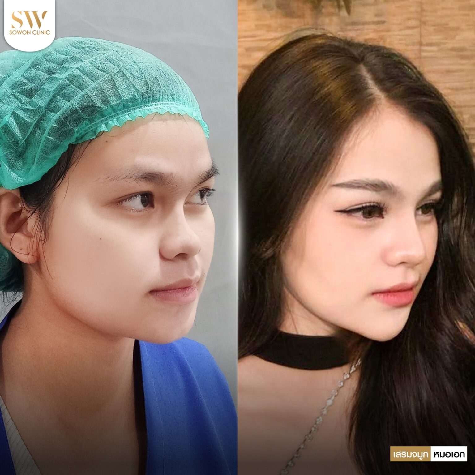 เสริมคางแบบไหนดี ให้เป๊ะปัง ปรับรูปหน้าให้จึ้งที่สุด! - SoWon Clinic